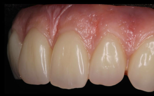 What are the most common types of dentures available?