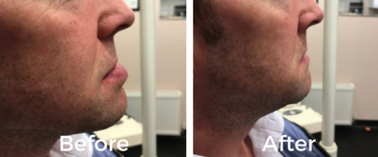 How to deal with poorly fitting dentures | Kevin Manners