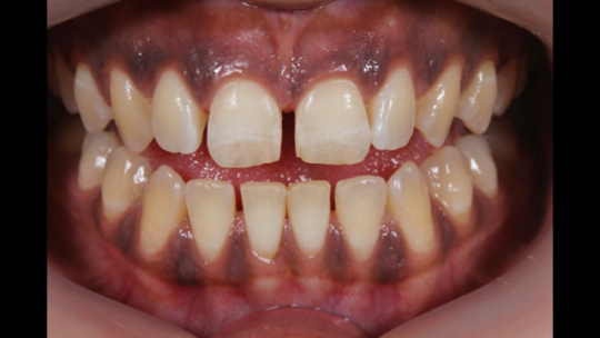 Denture wearers gum colour matching and contouring