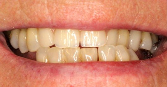 Is Your Denture Fitting Right? | Kevin Manners Clinics